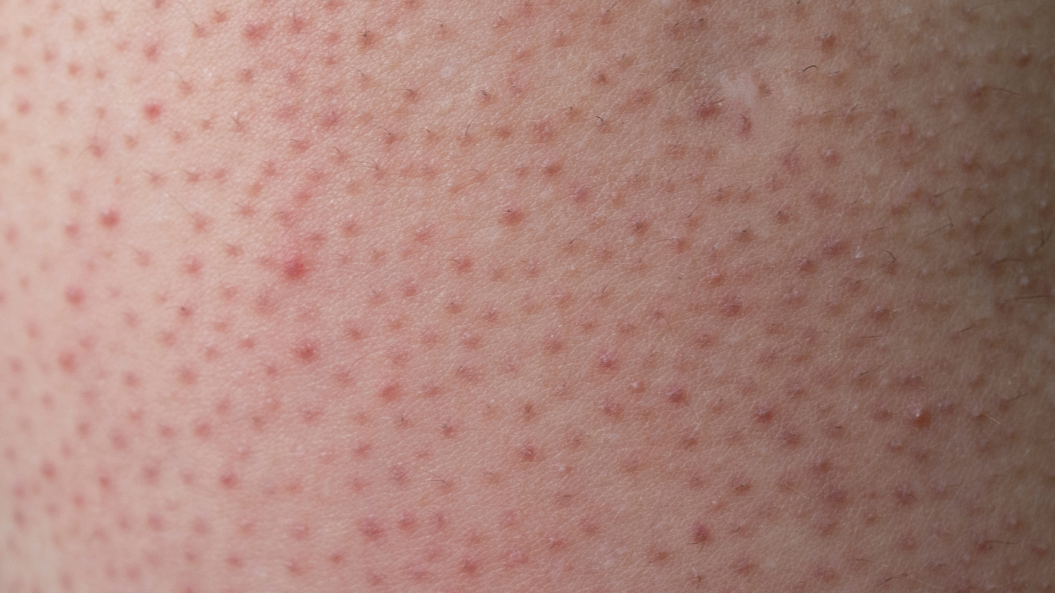 Queratosis Pilaris en la Cara: Qué Es, Por Qué Aparece y Cómo Tratarla ...